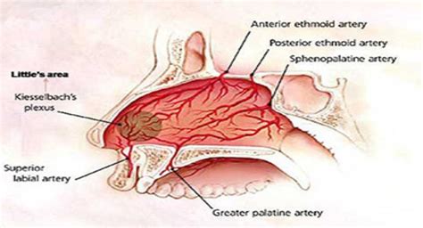 Download Free Medical Epistaxis Powerpoint Presentation