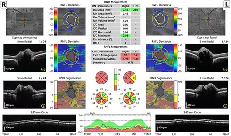 Navigating Visual Fields In Optic Nerve Head Drusen Mivision
