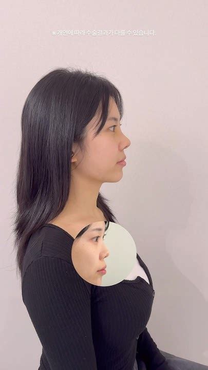 짧은 구축코 After🧡 니트성형외과 코재수술 코성형 Youtube