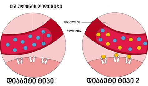 დიაბეტი ტიპი 1 კითხვა 4020 ქირურგიის ეროვნული ცენტრი