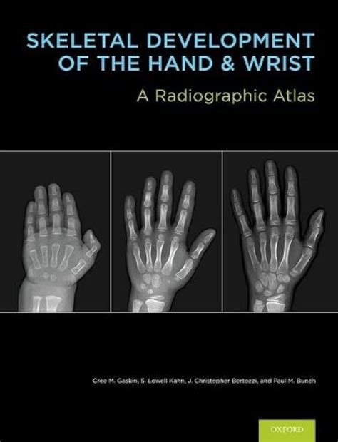 Skeletal Development Of The Hand And Wrist A Radiographic Atlas