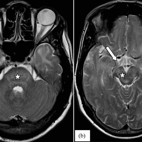MRI Axial Sections T2 Weighted A And B Showing A Diffuse Edema Of Download Scientific