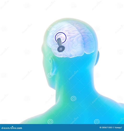 Link Neuralink New Artificial Intelligence Technology That Allows You To Connect To The Human