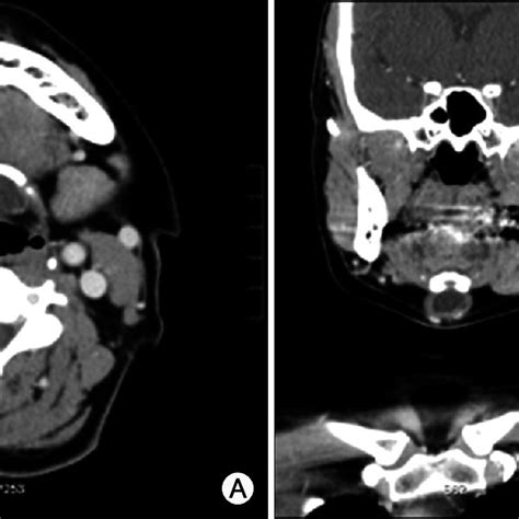 Transoral Approach Through A Midline Incision Of The Floor Of The