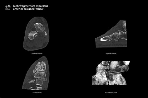 Perspektive Scs „fallvorstellung Mehrfragmentäre Processus Anterior