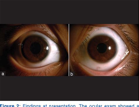 Figure 2 From Corneal Arcus And Xanthomas In Homozygous Familial