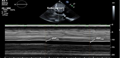Inferior Vena Cava Point Of Care Ultrasound Openanesthesia