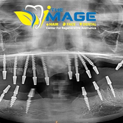 72 Hour Smile Makeover Basal Implants Unveiled The Image Hospital