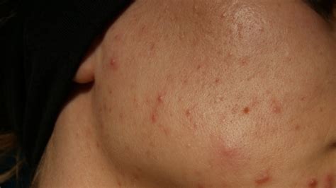 Как избавиться от подкожных прыщей Youtube