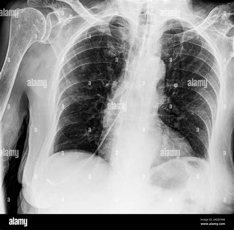 Incorrectly Positioned Nasogastric Tube X Ray Nasogastric Tubes Are