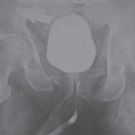 Retrograde Urethrography Months After Catheter Removalshowing Download Scientific Diagram