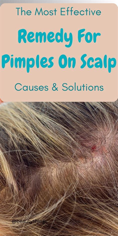 Effective Remedy For Acne Pimples On Scalp Pimples On Scalp Scalp