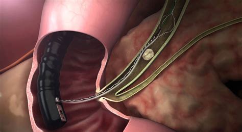 Best Ercp Stenting In Dadar Mumbai By Dr Gajanan Rodge Best Ercp Stenting In Dadar Mumbai By Dr Gajanan Rodge