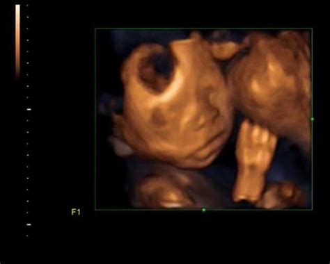 Successful 4d Ultrasound Imaging Of Fetal Face With Clear Facial Download Scientific Diagram
