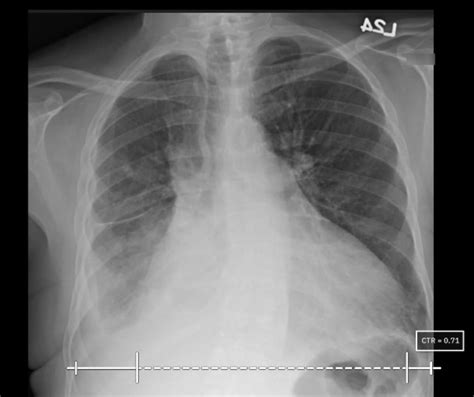 Fda Clears Ai Powered Cardiothoracic Ratio Assessment For Chest X Rays