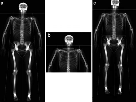 Participants Position And Delimitation Marks In DXA Scan Area For The Download Scientific