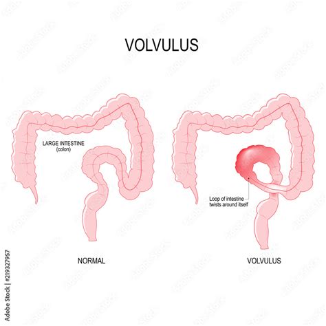 Volvulus Loop Of Intestine Twists Around Itself Stock Illustration