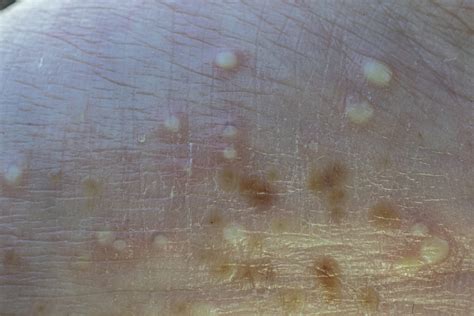 Spesolimab Rapidly Improved Pustular Symptoms In Gpp Rare Disease Advisor
