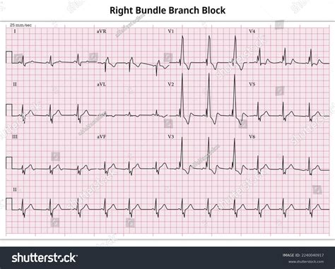 Ecg Rbbb Right Bundle Branch Block Stock Vector Royalty Free 2240040917 Shutterstock