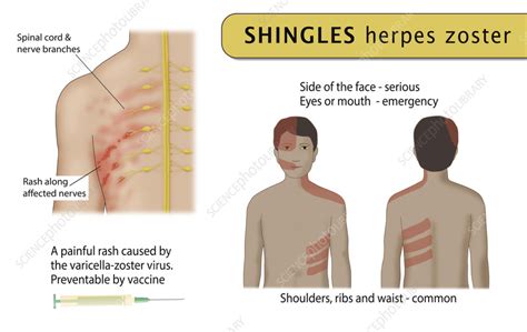 Shingles Rash Illustration Stock Image C0671039 Science Photo