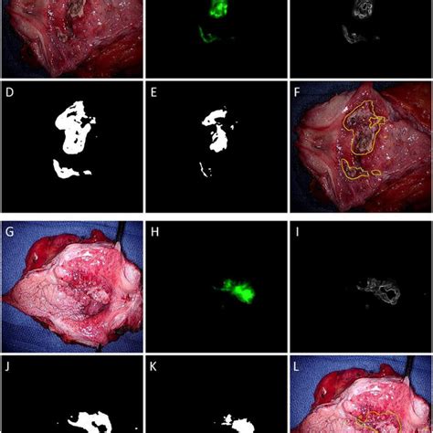 Ex Vivo Laparoscopic Cystoscopy Case 17 With High Grade Invasive