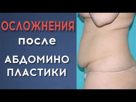 Осложнения после абдоминопластики: чем опасна операция? - YouTube