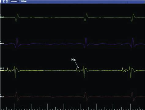 Intracardiac Signals Of His Potential Obtained From The Kodex Epd