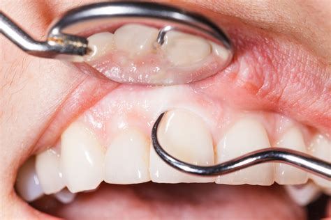 Gingivectomy Vs Gingivoplasty For Gum Related Issues Hoffman Dental Care