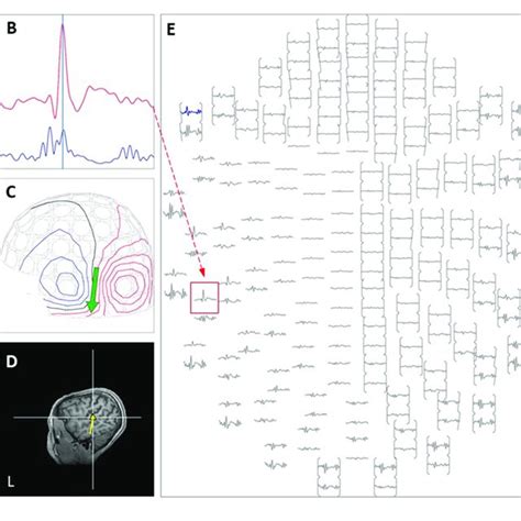 Case 1 A E An Example Of An Individual Simultaneous Meg Eeg