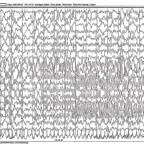 Patient No 6 An Ictal Eeg Recording Of The Patient With Left Temporal