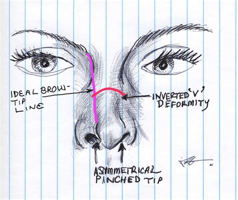 Nasal Deformity Diag Dr Haworth