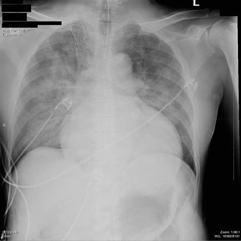 Chest X Ray Showing Bilateral Interstitial Fluffy Infiltrates And Chest X Ray Showing Bilateral Interstitial Fluffy Infiltrates And