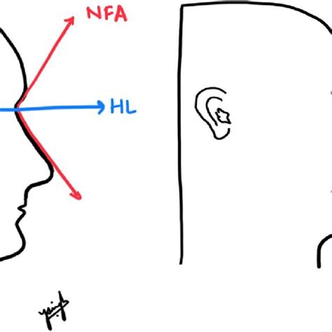 3 4 Demonstrating Nasofrontal Angle Nfa And Nasofacial Angle Nfa
