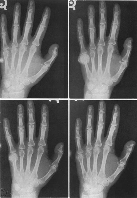 Hyperparathyroidism X Ray