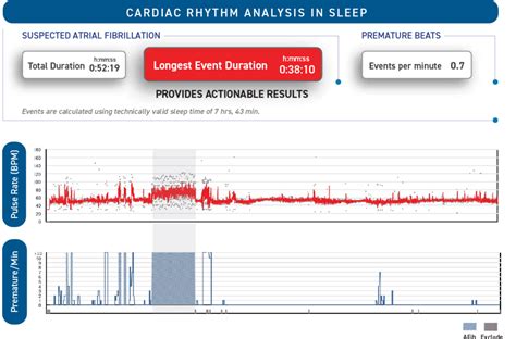 Arrhythmia Detection Zoll Itamar
