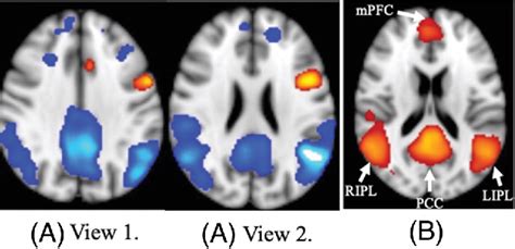 Figure 1 From Functional Mri Shows Altered Deactivation And A Corresponding Decrease In