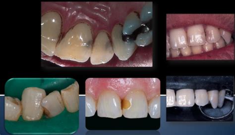 Class Iii Composite Tooth Preparations Flashcards Quizlet