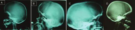 A Lateral Skull Radiograph Of A 5 Year Old Girl Showed Hyperostosis Download Scientific
