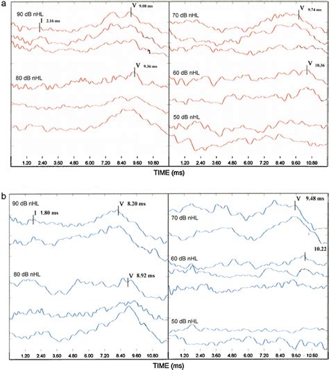 a abr right ear traces are desynchronized with a long latency v