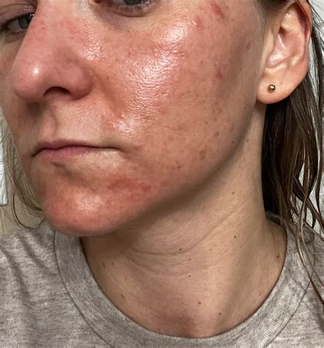 Pod Update Rperioraldermatitis