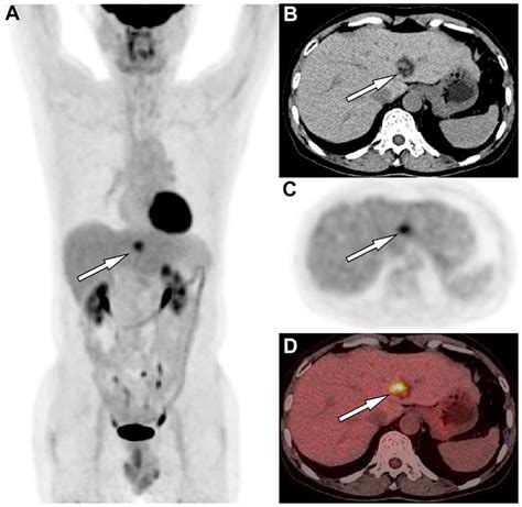 A The Maximum Intensity Projection Of The Positron Emission Download Scientific Diagram
