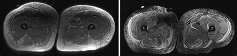 Axial MRI Scan Showing Diffuse Edema Of All Muscle Compartments In Both Download Scientific