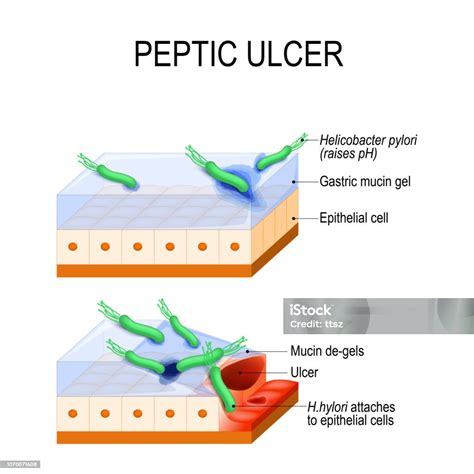 위 궤 양 그리고 세균성 감염입니다 이 다이어그램에 헬리코박터 Pylor 메커니즘 건강관리와 의술에 대한 스톡 벡터 아트 및