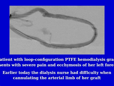 Ppt Patient With Loop Configuration Ptfe Hemodialysis Graft Dokumen