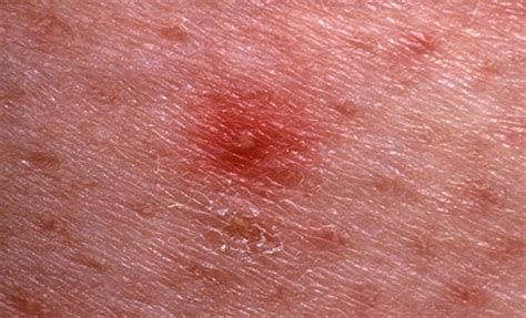 What Does T Cancer Skin Rash Look Like