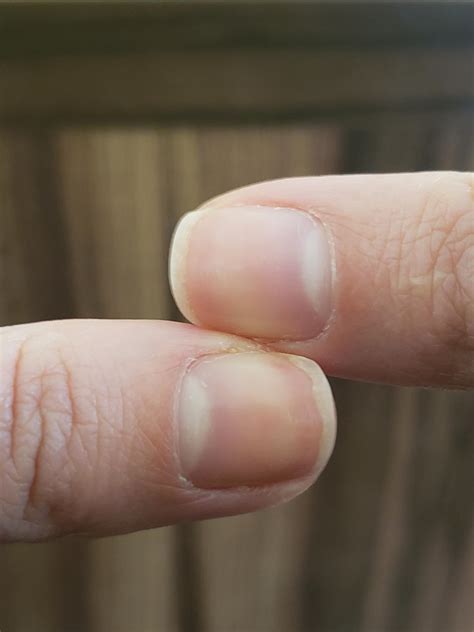 Do You Know What May Cause The Uneven Nail Bed It Was Present Since I Can Remember But Has Got