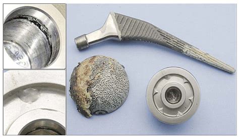 Retrieved Analysis Of Revised Modular Mom Tha 56 Mm Acetabular Download Scientific Diagram