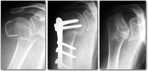 Intramedullary Locking Nail Fixation Of Proximal Humerus Fractures