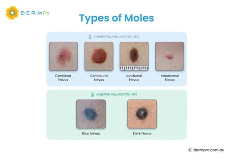 Types Of Moles And Skin Lesions Signs And Differences