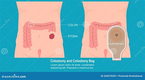 Ileostomy Stoma Surgical Opening Of Small Intestine Vector Illustration